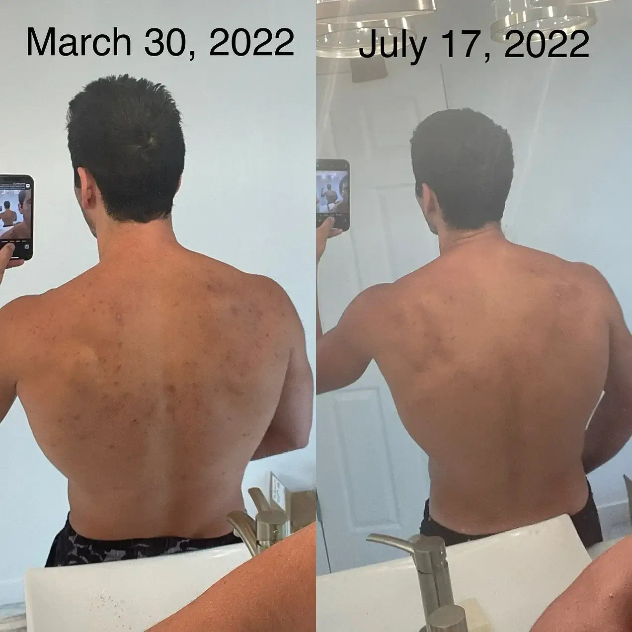 How to Clear Back Acne & Fade Dark Spots Fast